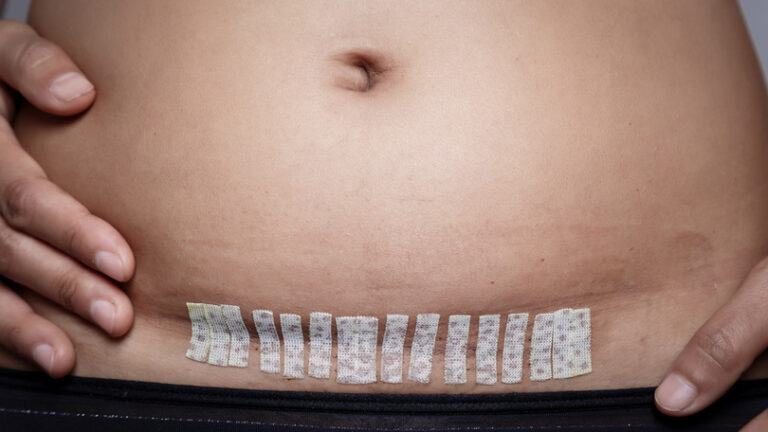 Hysterektómia - kedy a u koho je potrebná? | lekar.sk