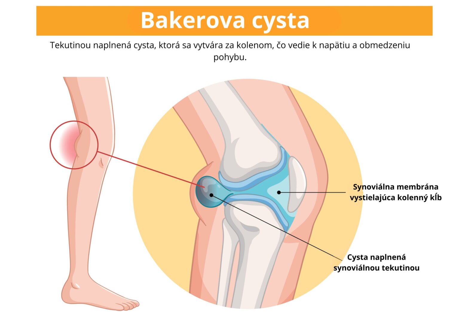 Bakerova cysta (cysta pod kolenom) | lekar.sk