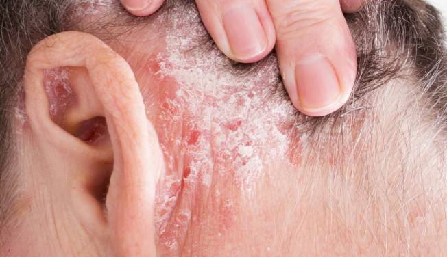 Psoriáza | Lekár.sk