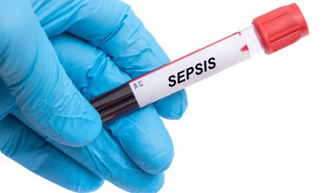 Sepsa | lekar.sk