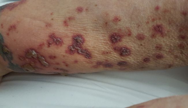 Potia sa vám v lete nadmerne ruky? Pozor na dyshidrotický ekzém | Lekár.sk