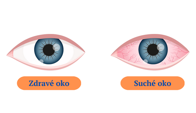 Stačí pri začervenanom oku teplý obklad a domáca liečba alebo treba ...